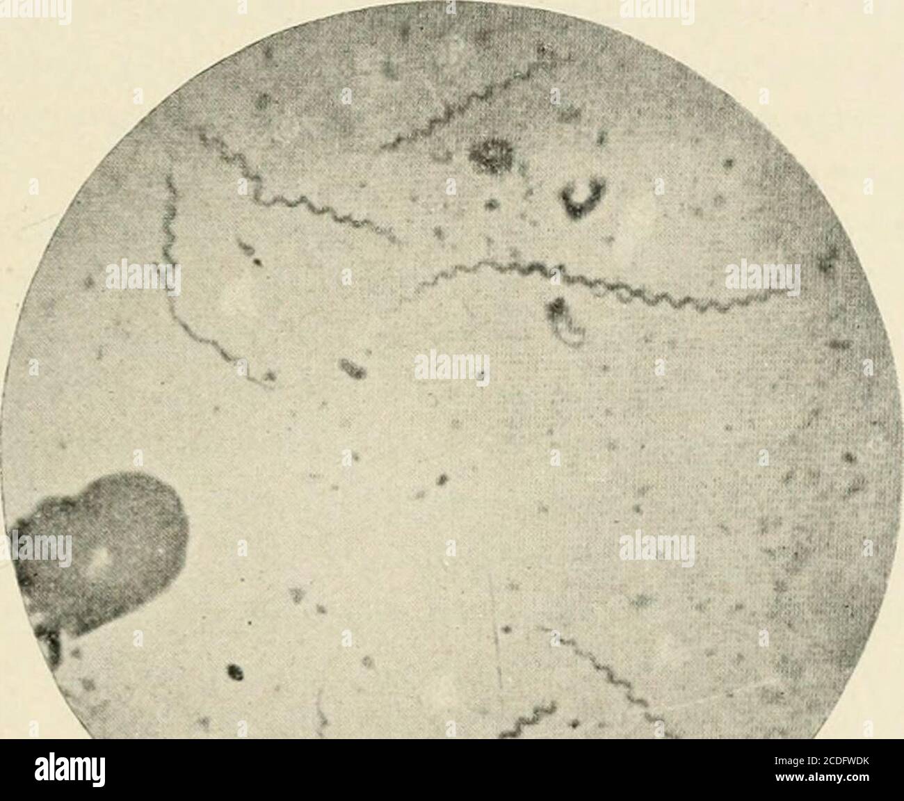 Syphilis chancre hi-res stock photography and images - Alamy