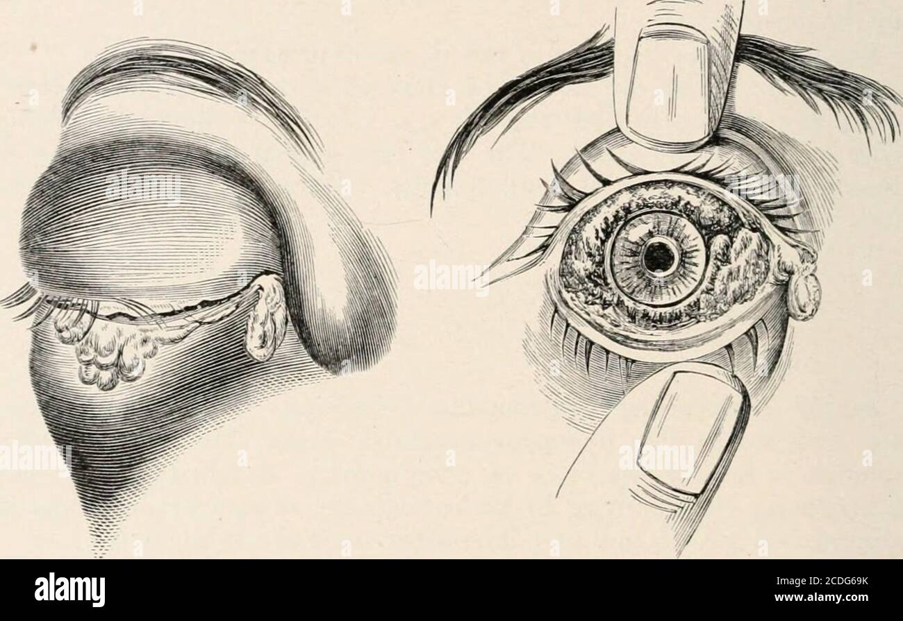 Neonatorum hi-res stock photography and images - Alamy