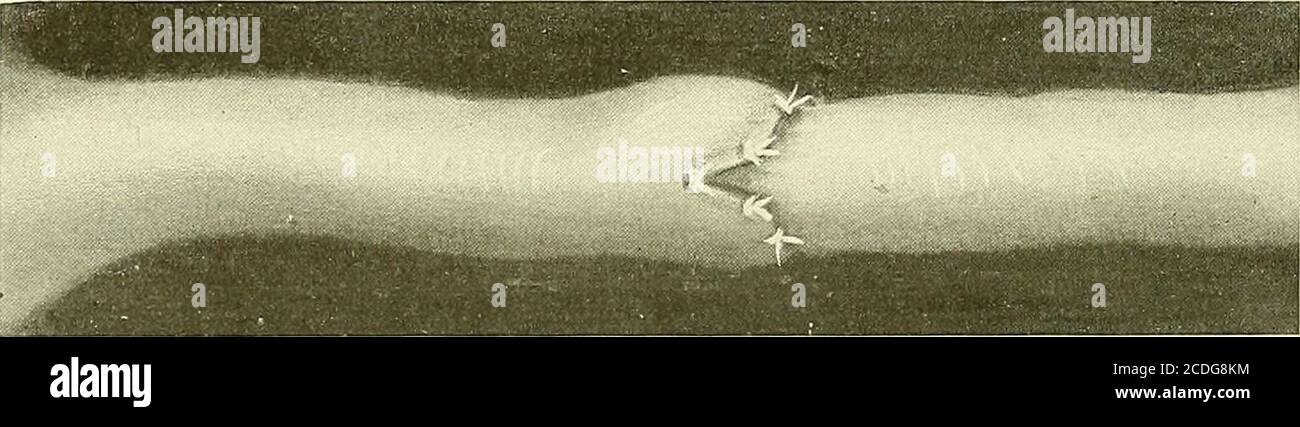 . Gynecology : . Fig. 473.—Ureteral Anastomosis (End to End).Manner of ...