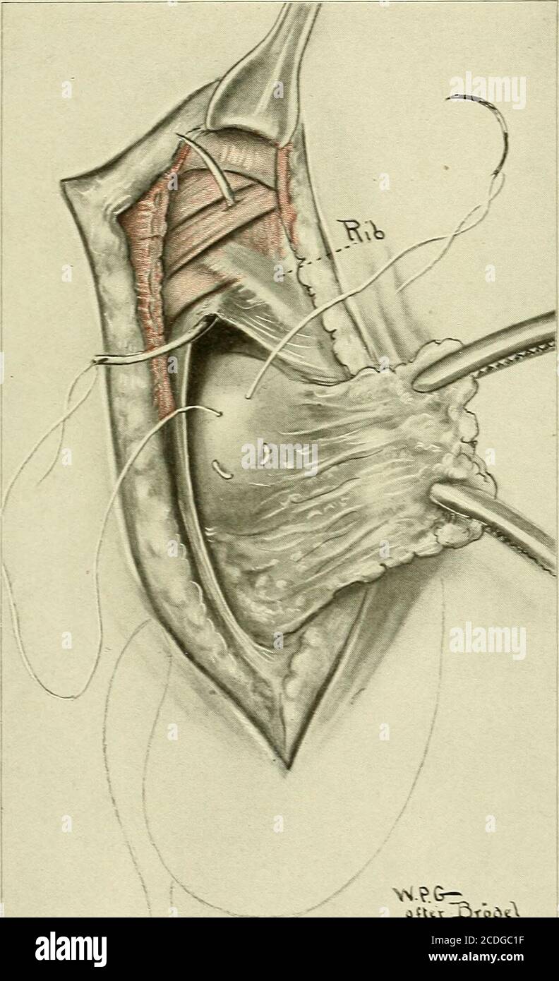 . Gynecology : . Fig. 461.—SrsPEXSiox of Kidxet. The latissimus dorsi ...