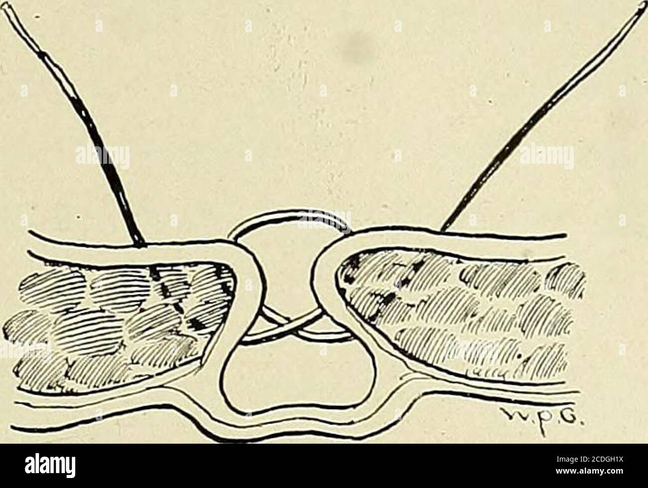 Diastasis recti hi-res stock photography and images - Alamy