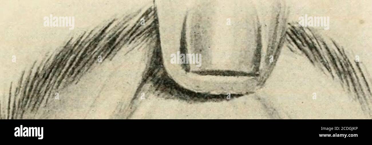 Vernal conjunctivitis hi-res stock photography and images - Alamy