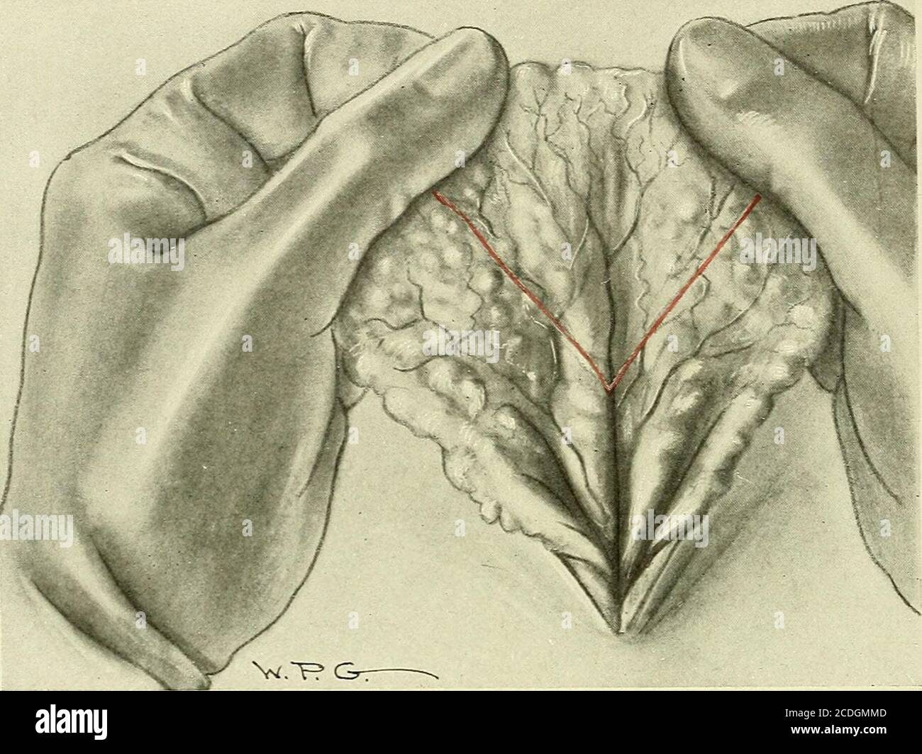. Gynecology : . Fig. 414.—Abdominal Myomectomy.The wound in the ...