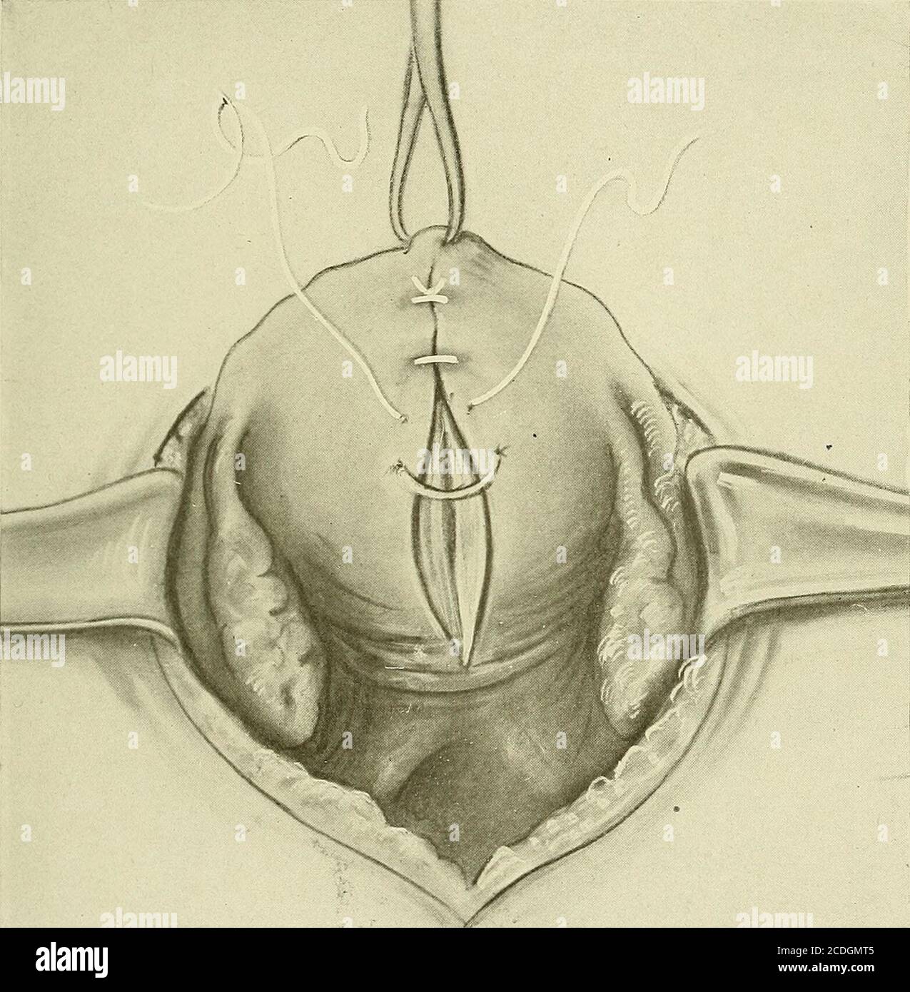 Myomectomy High Resolution Stock Photography and Images - Alamy