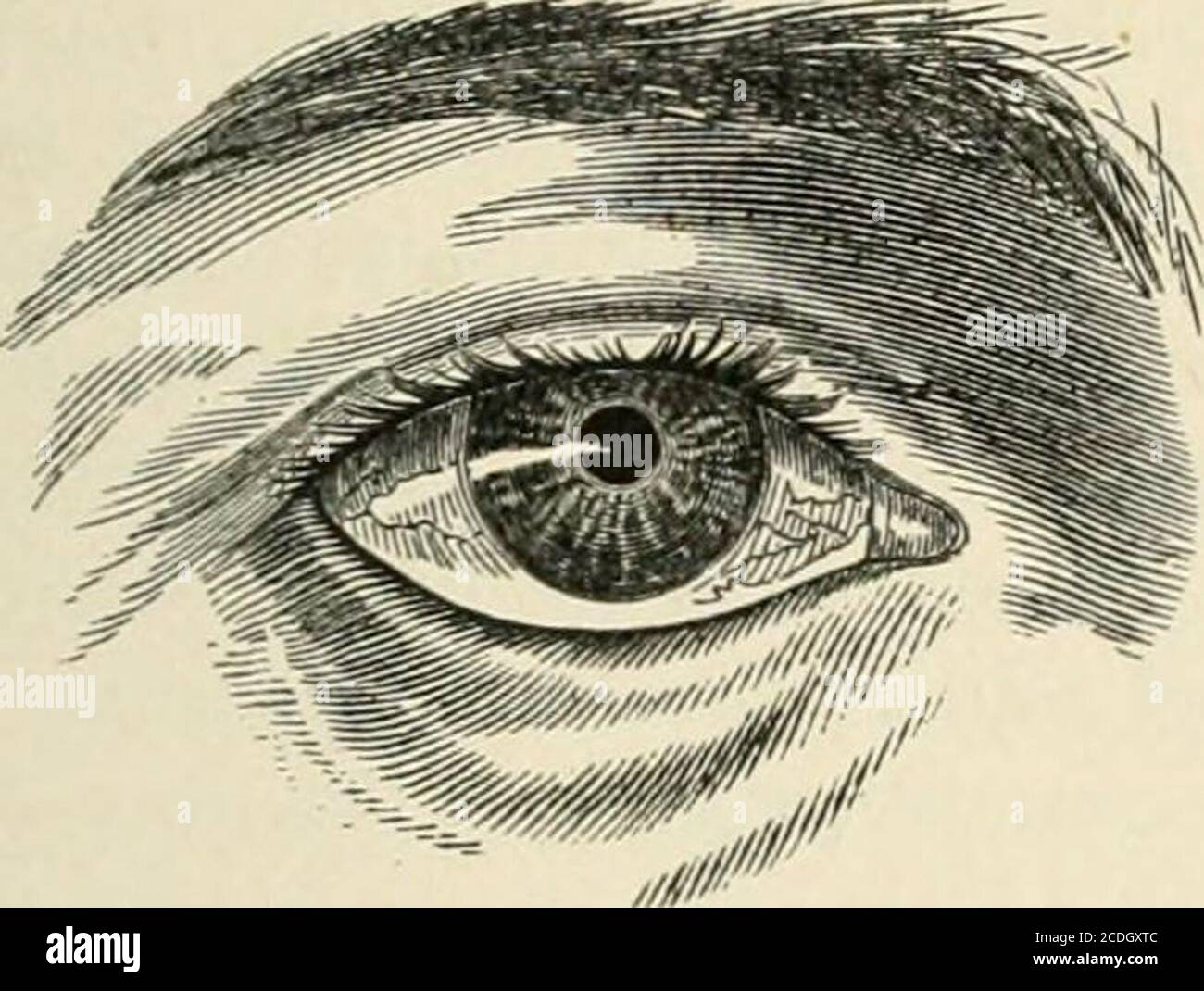 Collodion bandage hi-res stock photography and images - Alamy