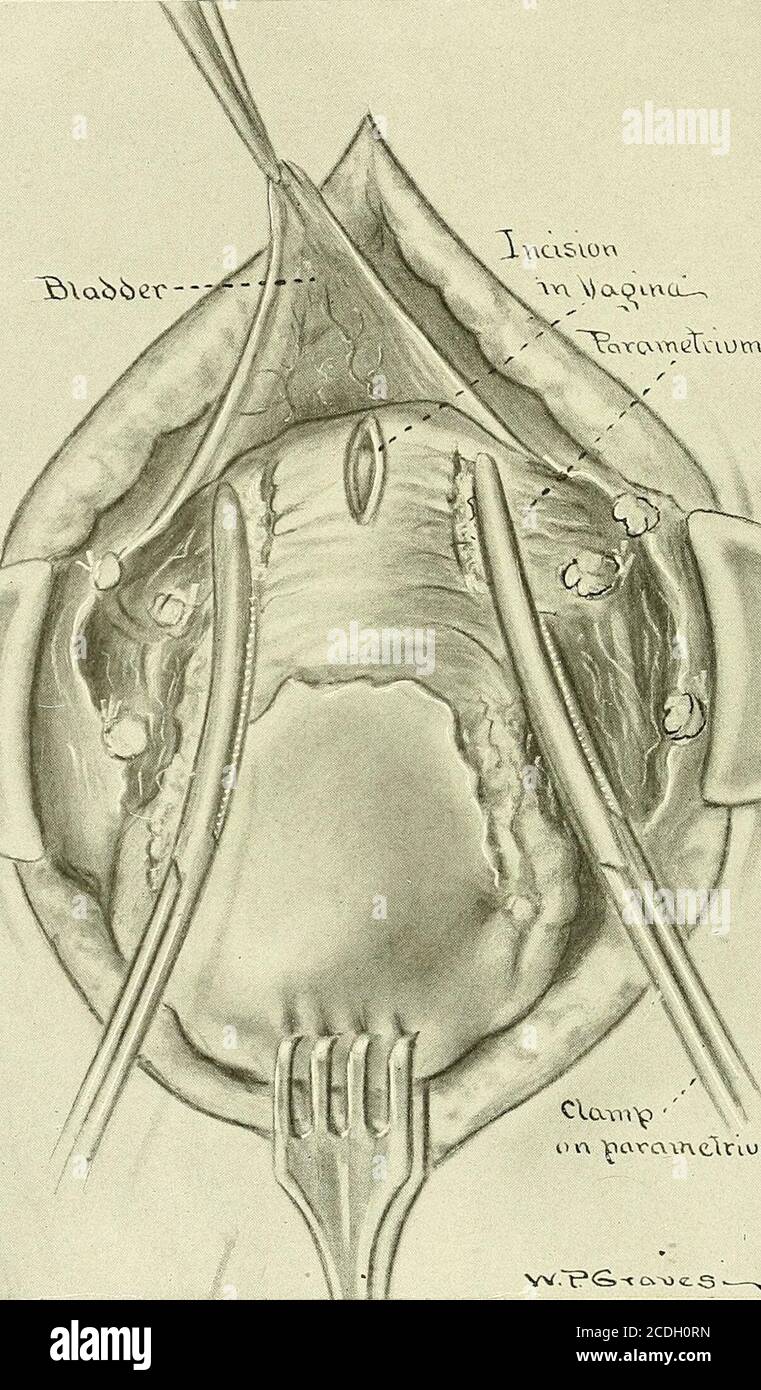 . Gynecology : . Vi P-Gcaots- Fig. 387.—Hysterectomy with Removal of ...
