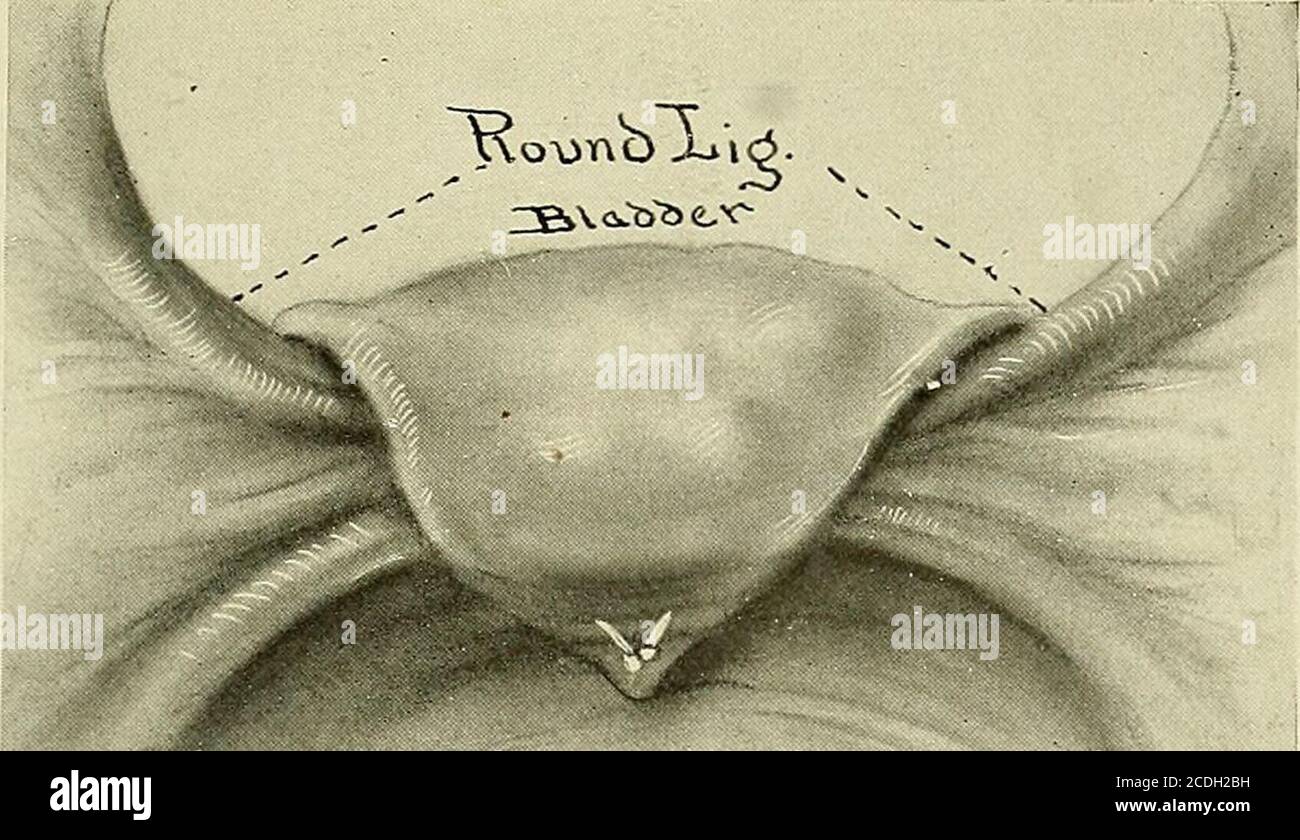 Round Ligament Palpation