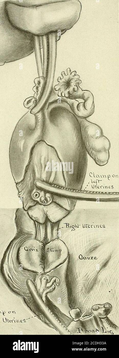 . Gynecology : . Fig. 376.—Supravaginal Hysterectomy. Second Step of ...