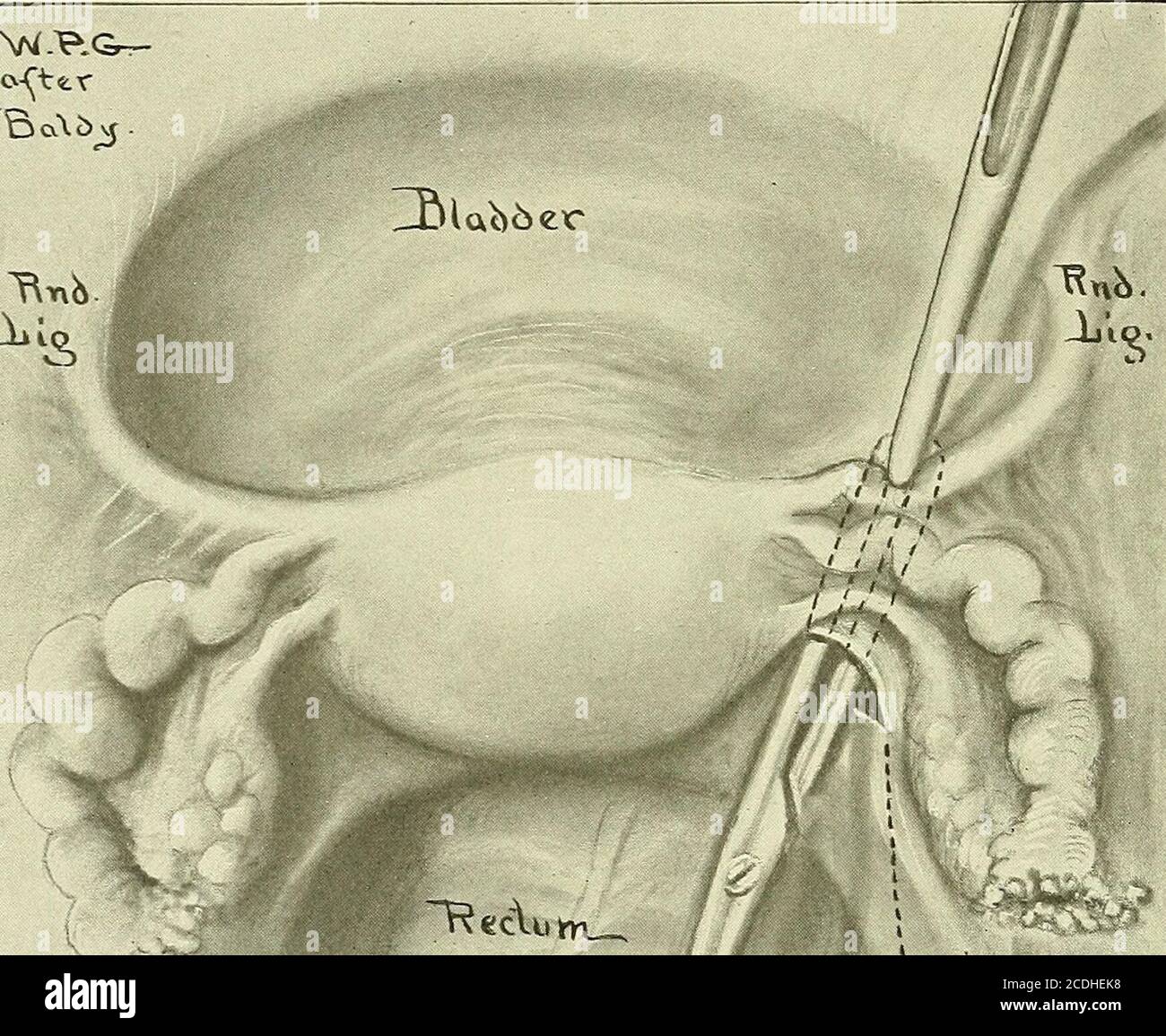Trendelenburg position hi-res stock photography and images - Alamy