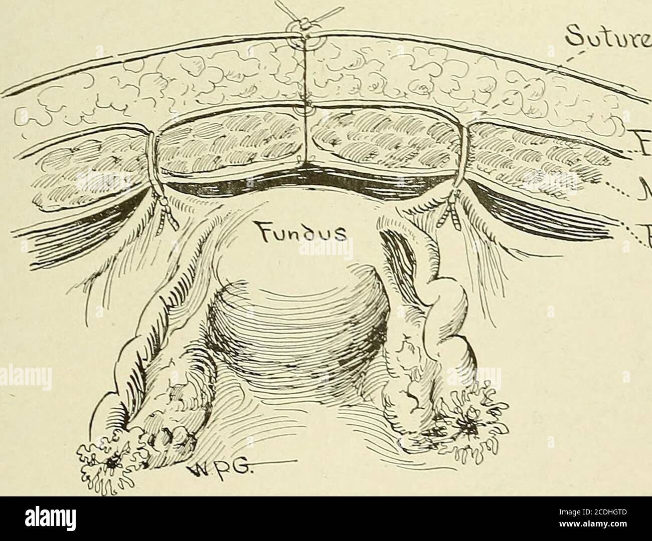 . Gynecology : . Fig. 332.—Oishatjsens Operation* Viewed from Within ...