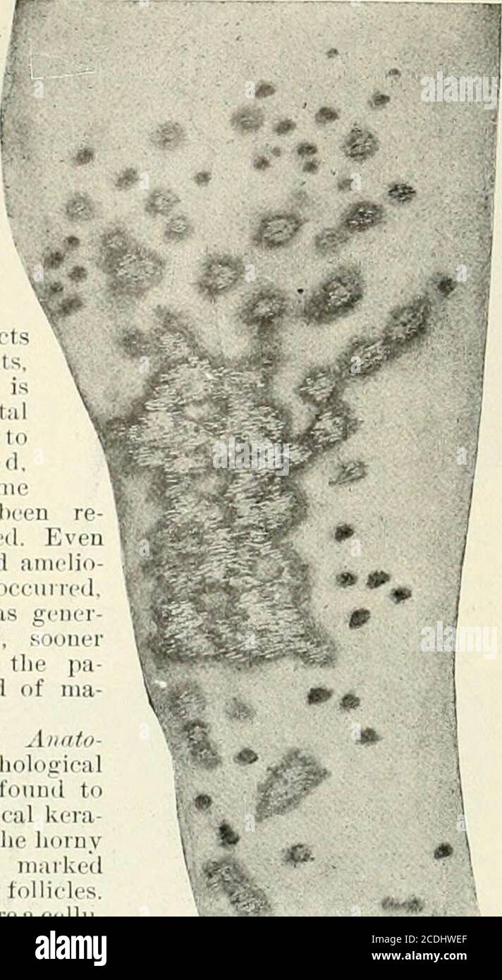 Lichen ruber planus hi-res stock photography and images - Alamy