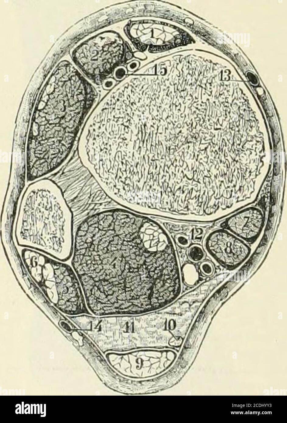Anasarca hi-res stock photography and images - Alamy