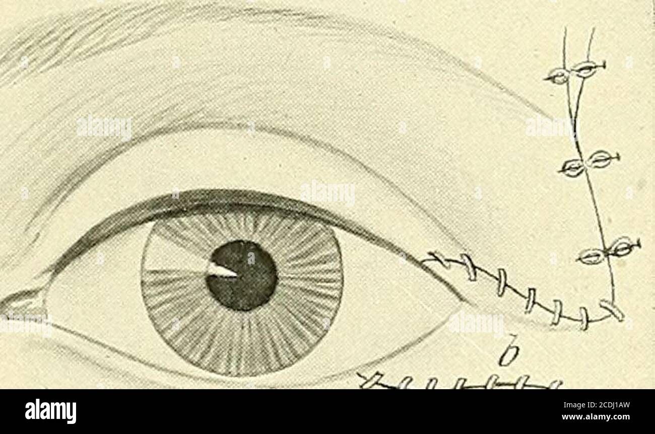 Necrotic nose hi-res stock photography and images - Alamy