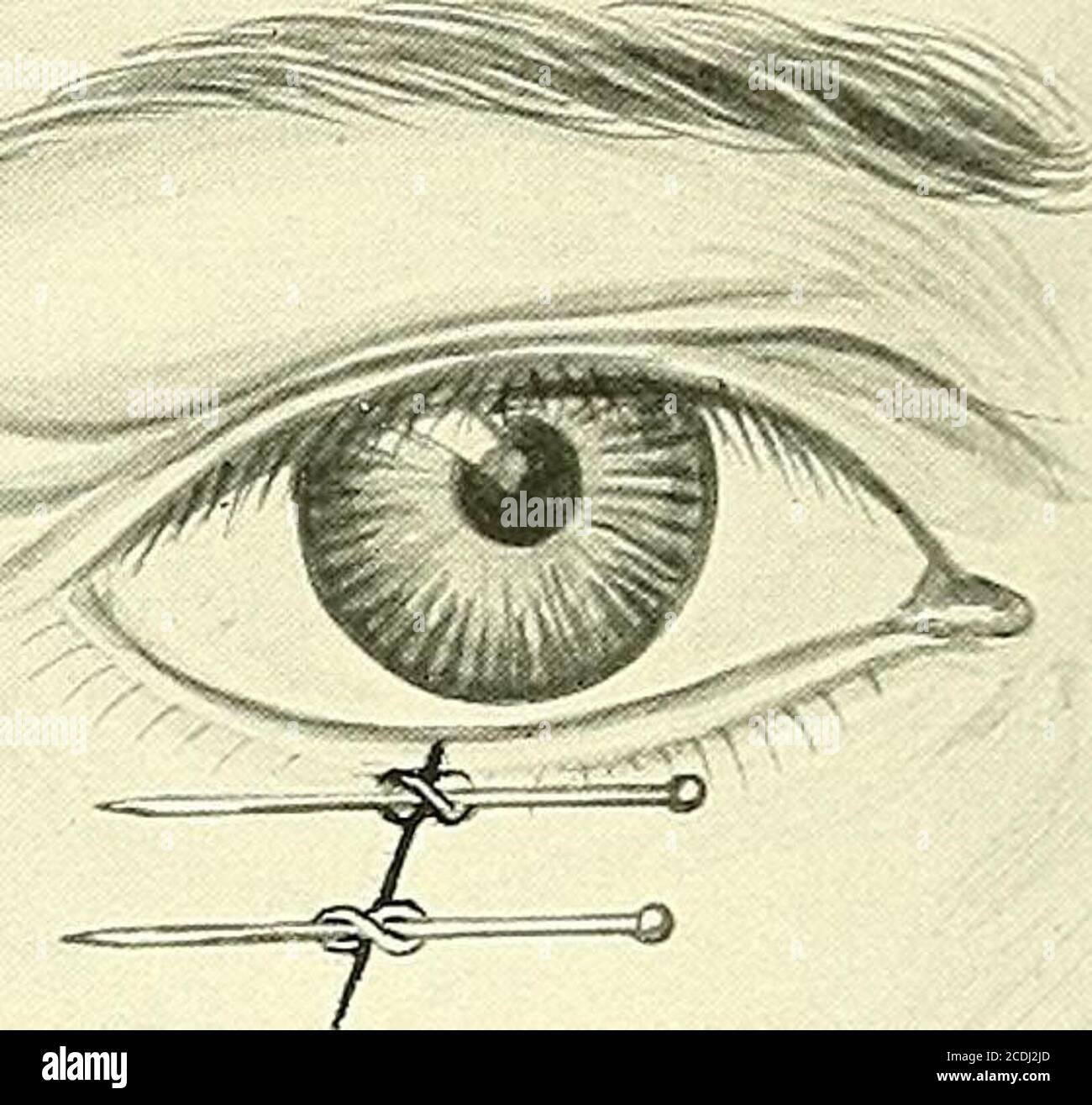 blepharitis operation