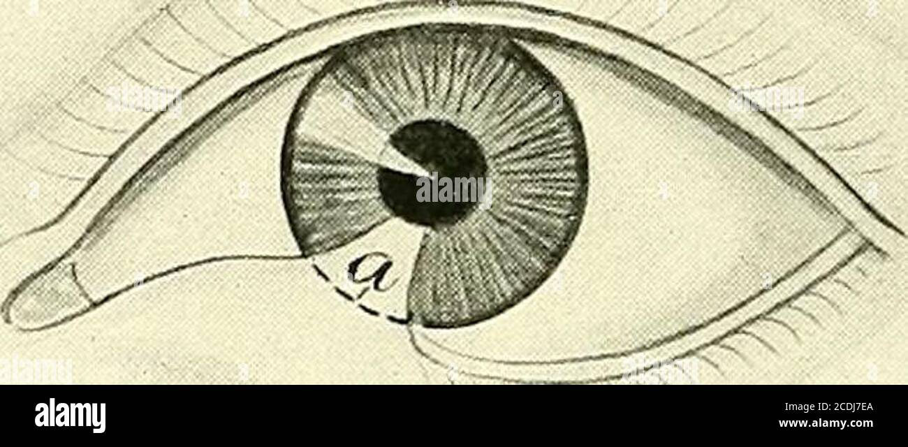 Symblepharon hi-res stock photography and images - Alamy