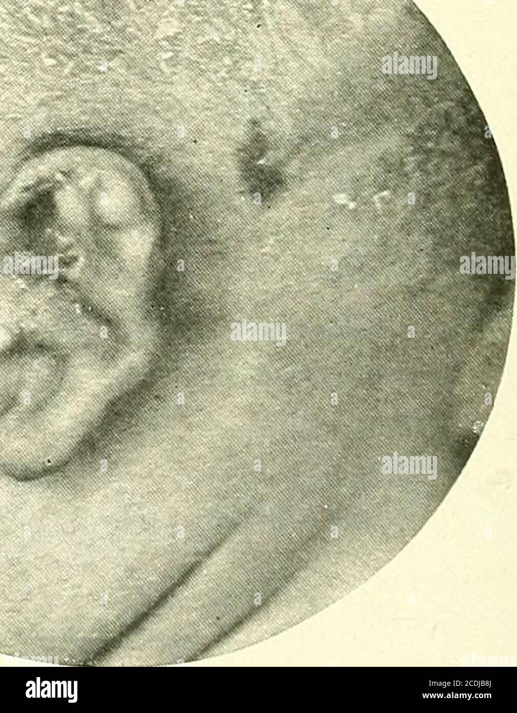 Malformed ear hi-res stock photography and images - Alamy