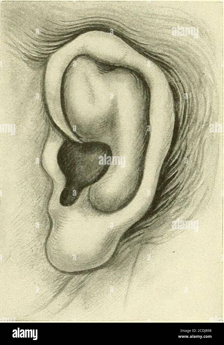 Othematoma hi-res stock photography and images - Alamy