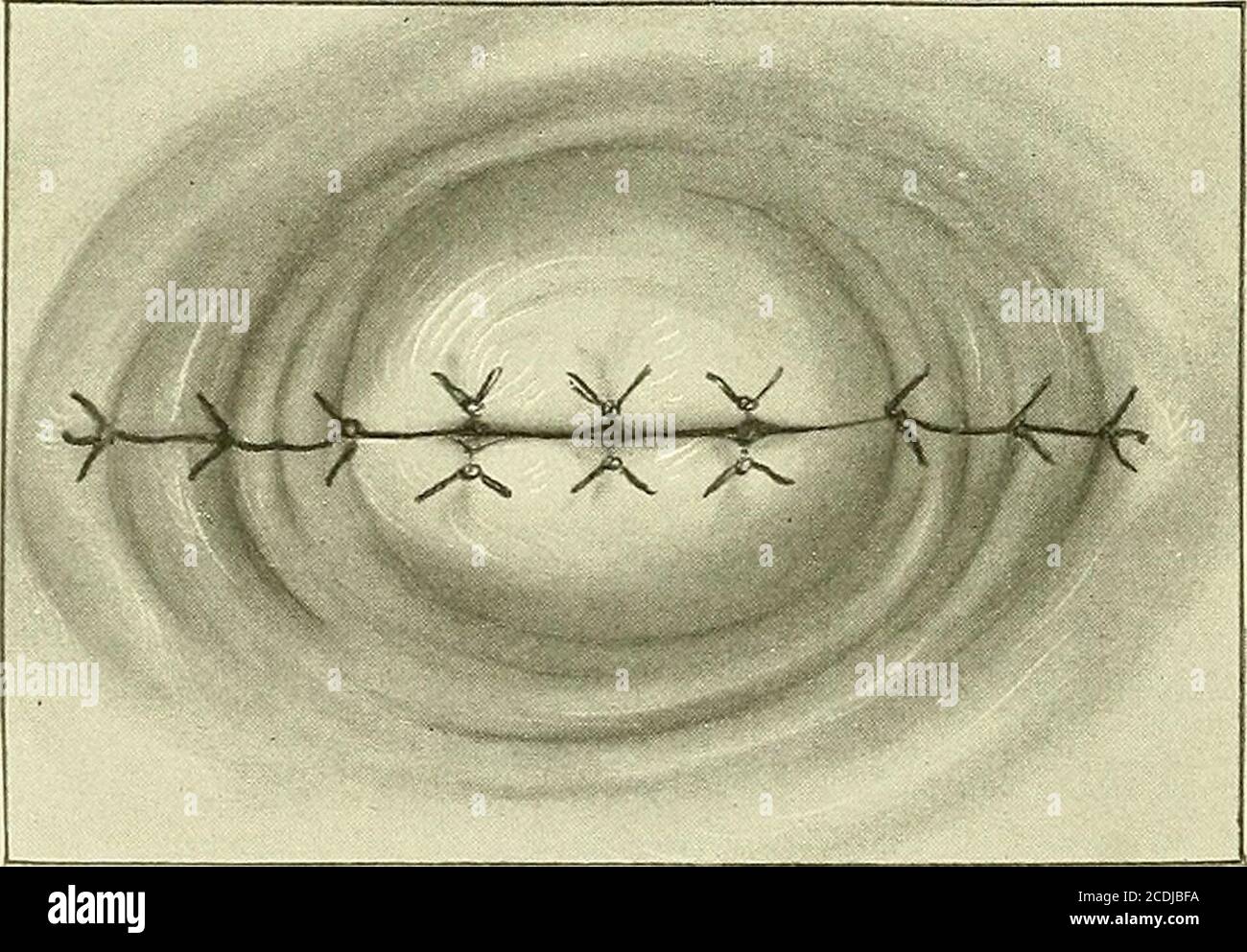 . Gynecology : . Fig. 237.—Amputation of the Cervix.Hegars method ...