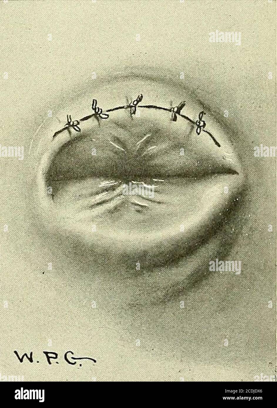 Sewing lips hi-res stock photography and images - Alamy