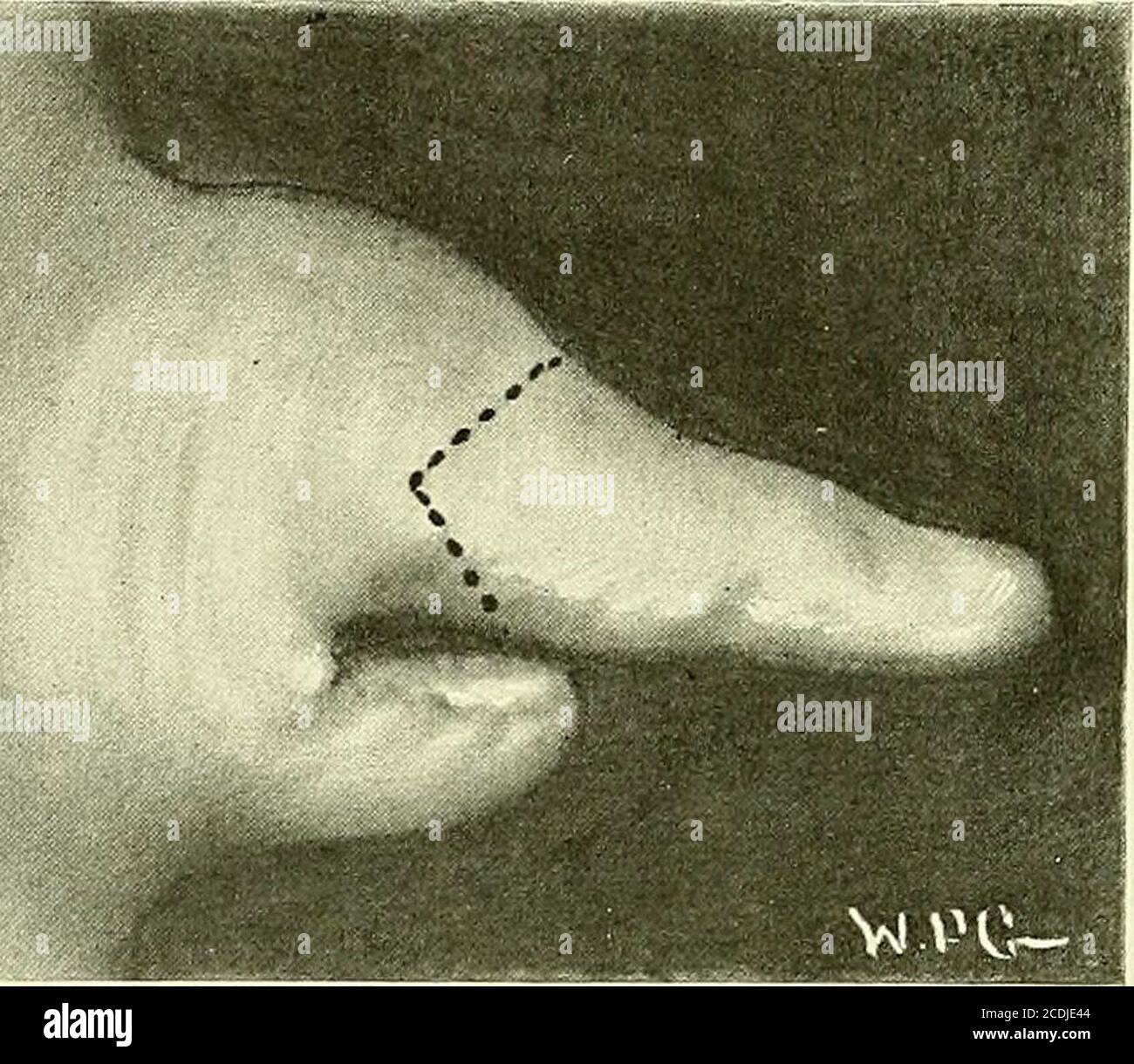 . Gynecology : . Fig. 226—Tracheloplastt.Creating a new angle when one ...