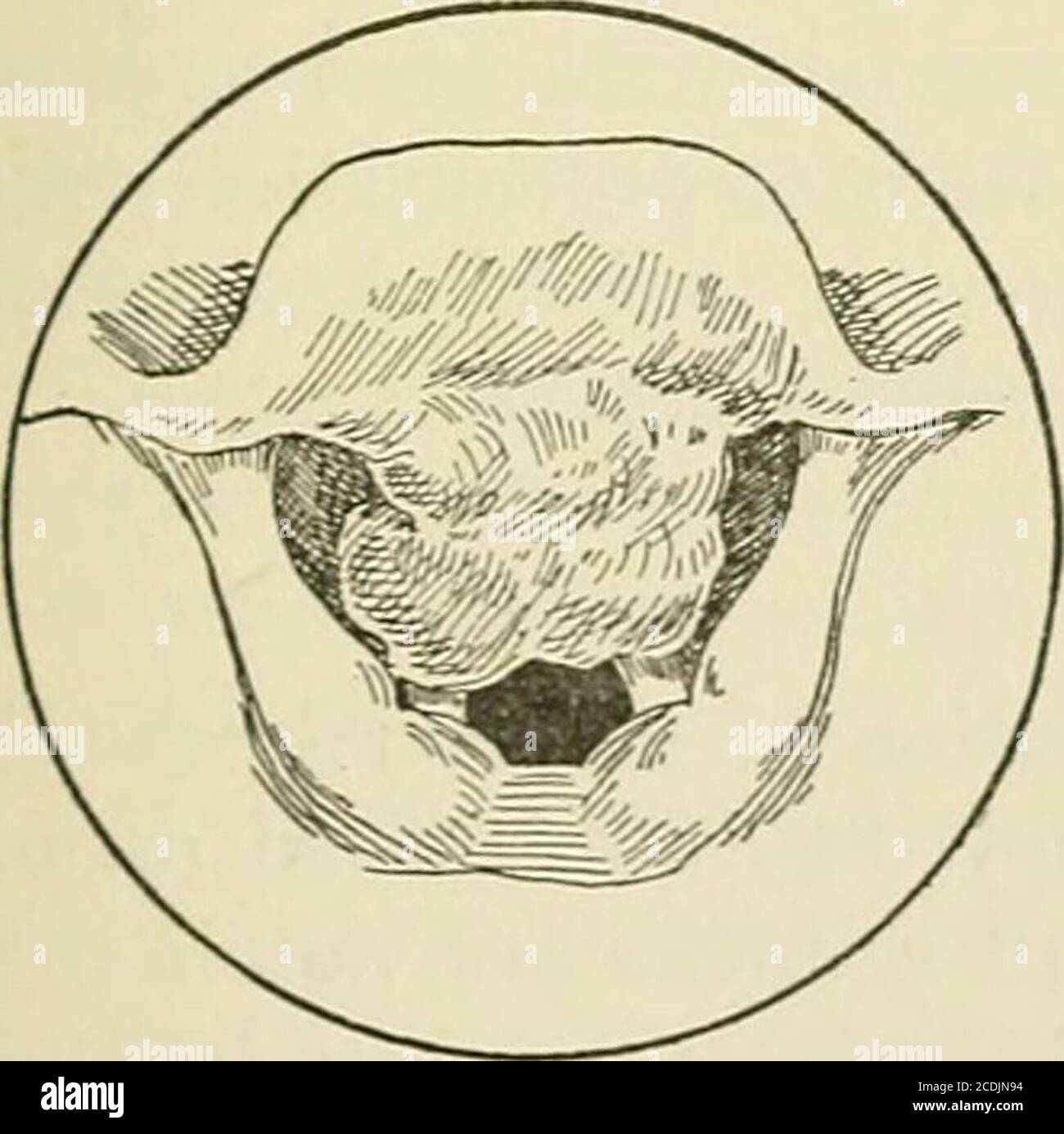 Cystoma hi-res stock photography and images - Alamy