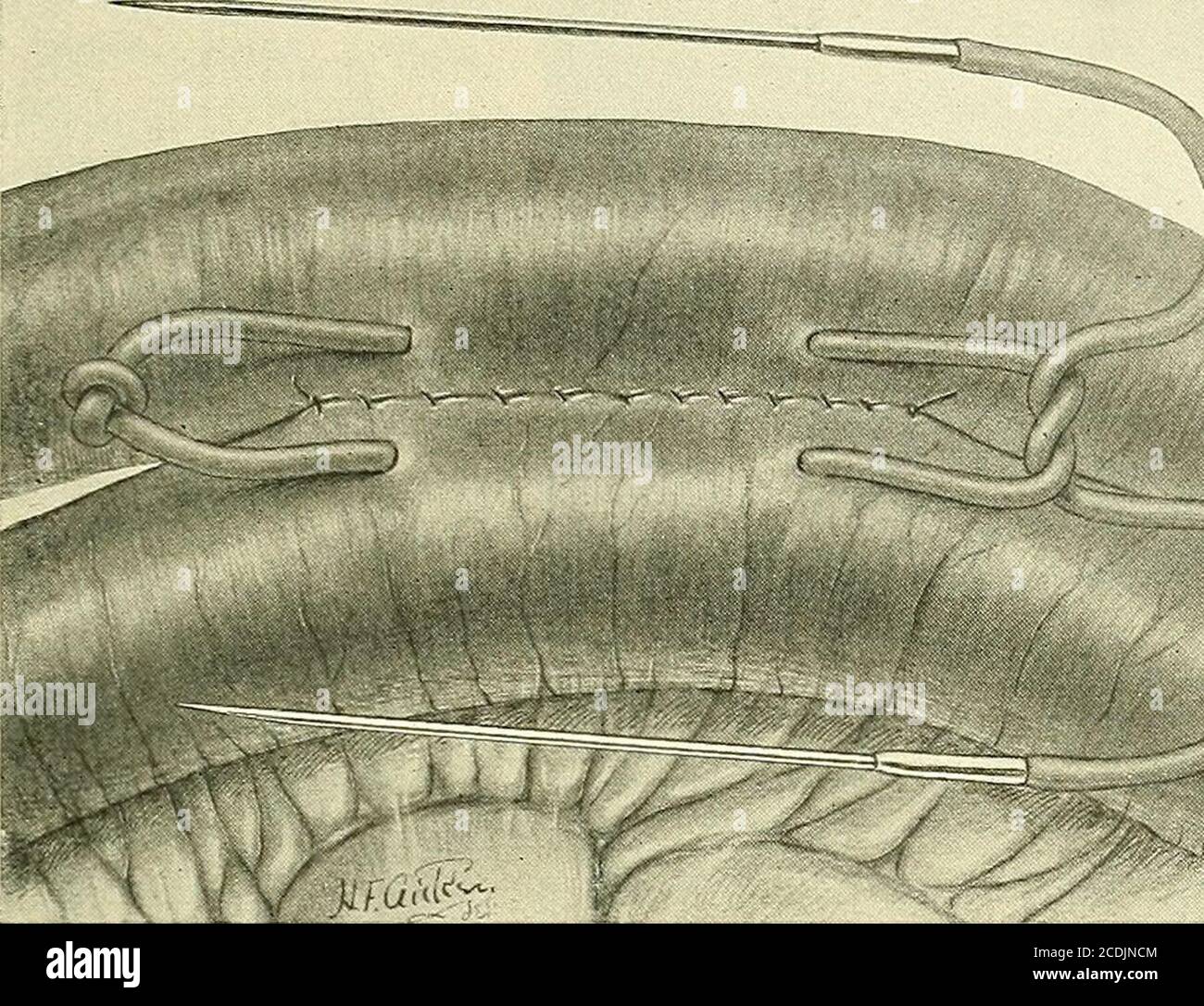 . Surgery, its principles and practice . Fig. 397.—Connells Suture ...