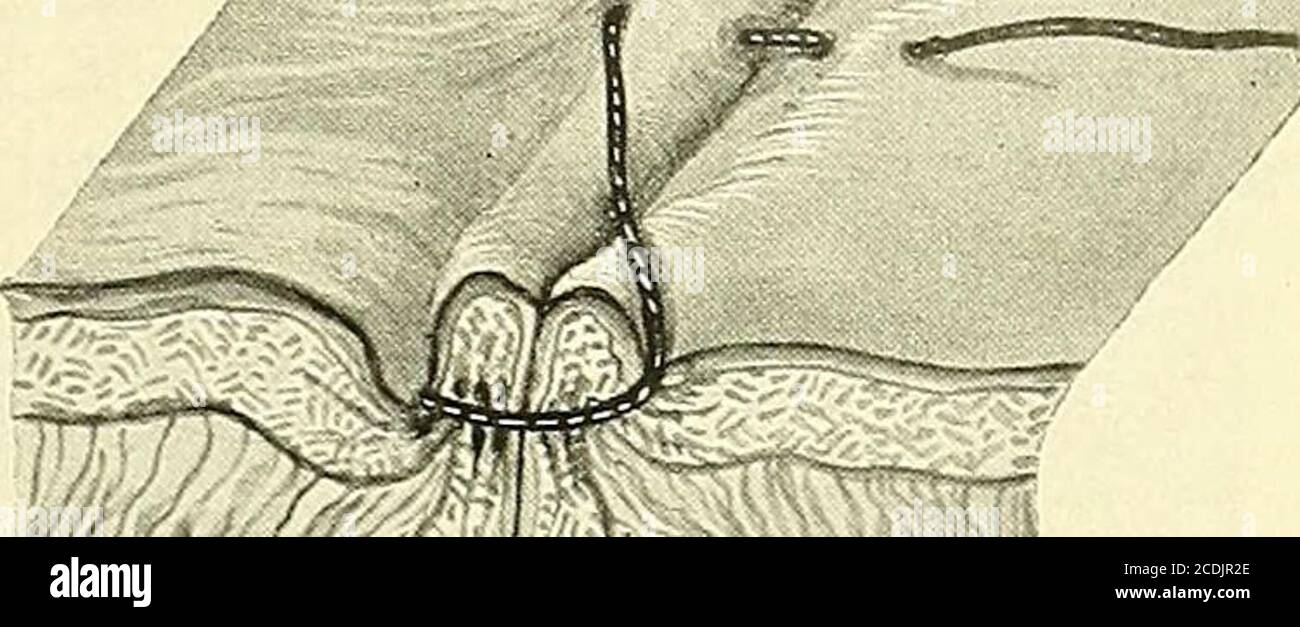 . Surgery, its principles and practice . ontinuous Lem-bert sutures are ...