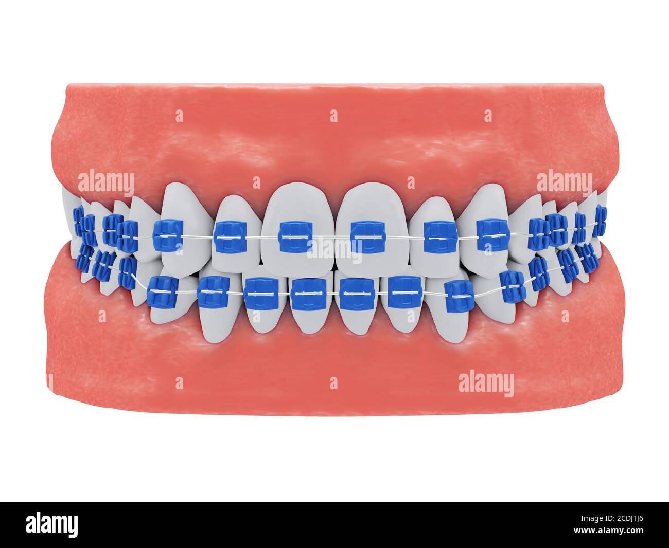 Human jaws with healthy teeth and blue braces, front view isolated, 3d ...