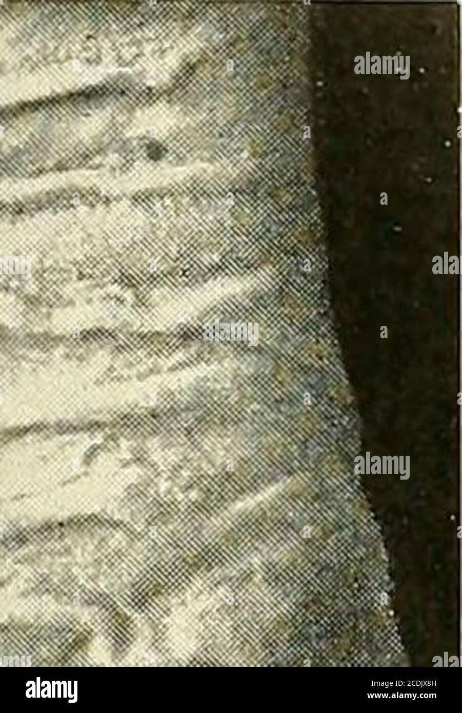 . Surgery, its principles and practice . Fig. 380.—Intestinal ...