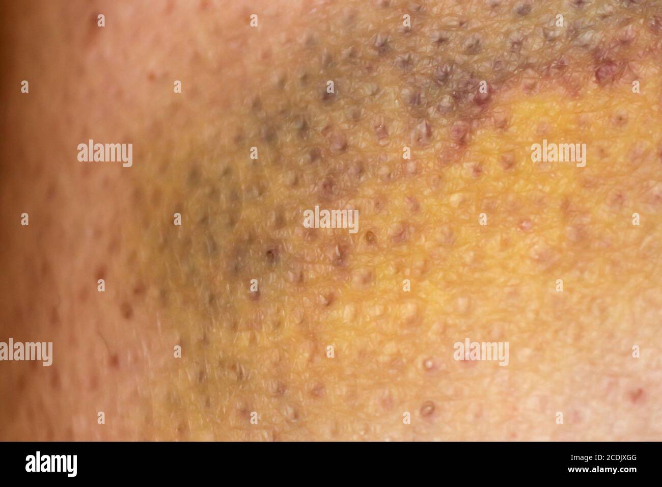 Large bruise hematoma on the humans leg on the skin in different colors ...