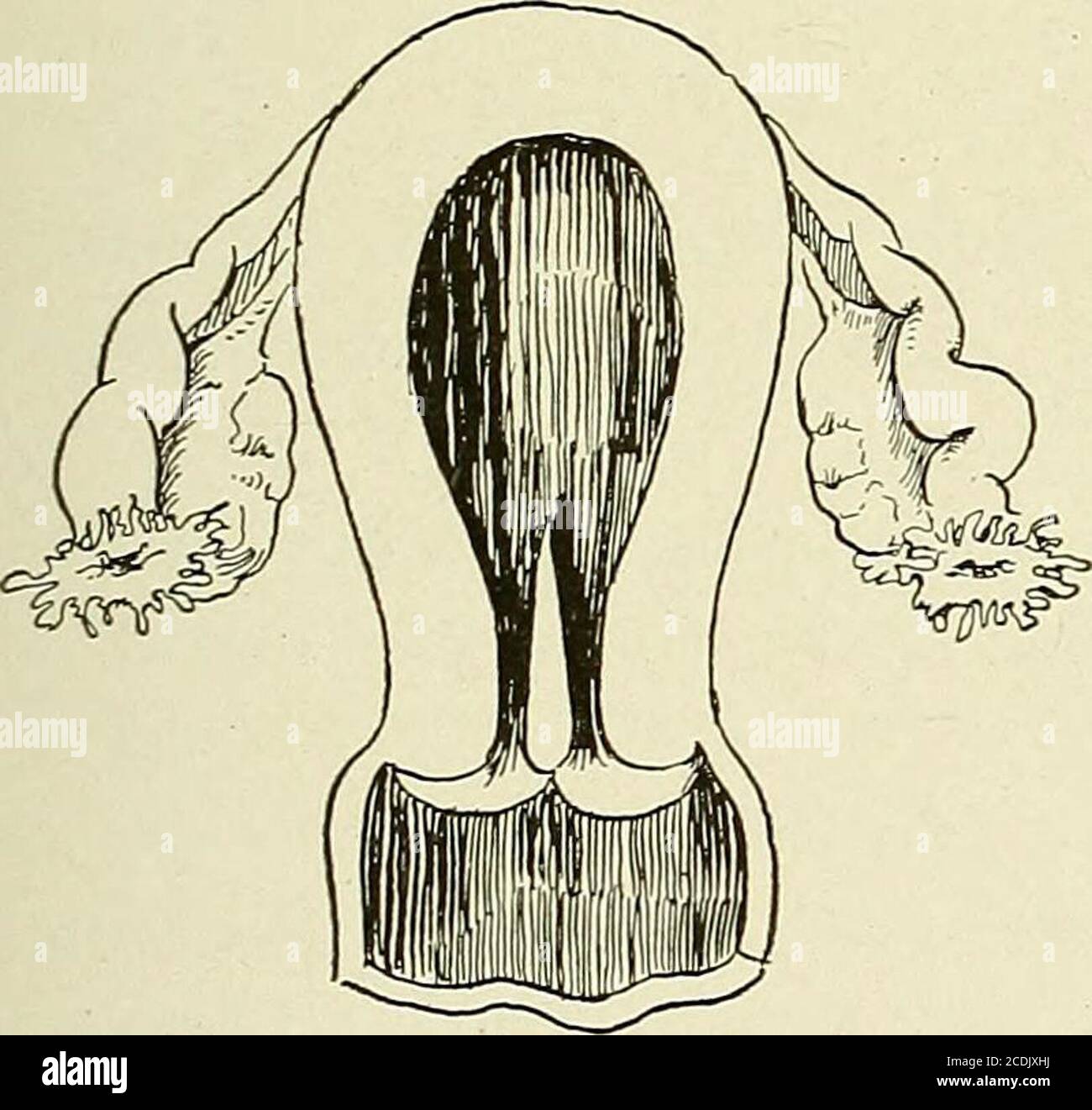 . Gynecology : . Fig. 173.—Uterus Subseptus Uniforis. Partial Septum of ...