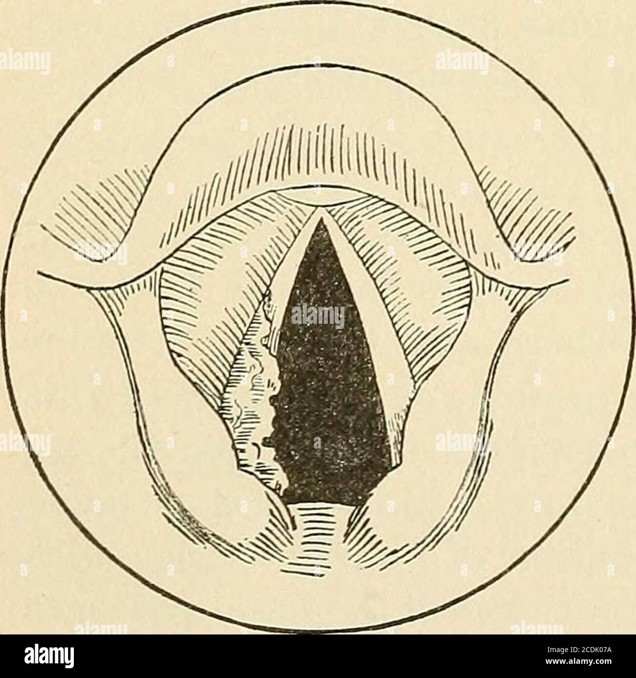 Atrophic rhinitis hi-res stock photography and images - Alamy