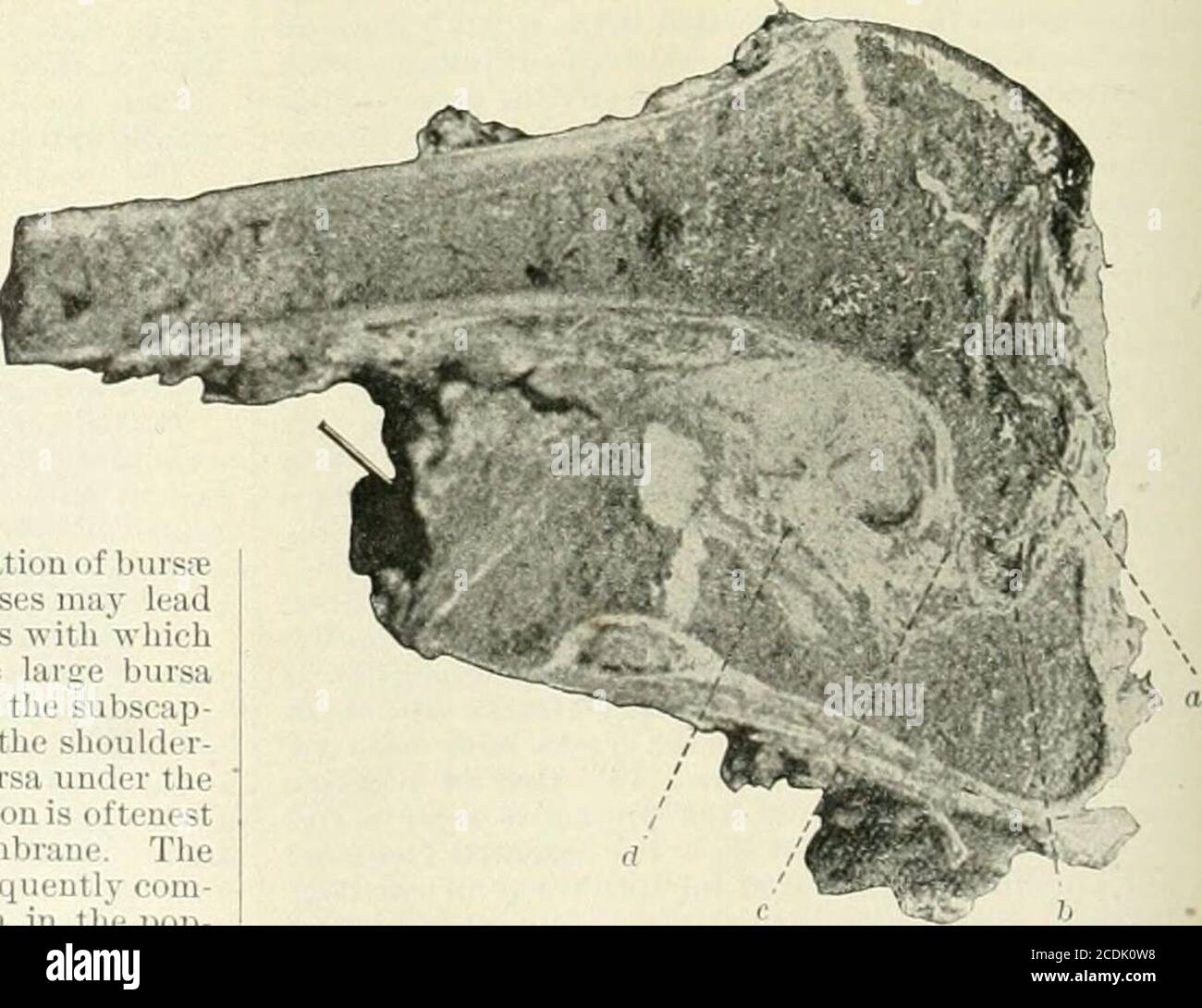 Formation of an abscess hi-res stock photography and images - Alamy