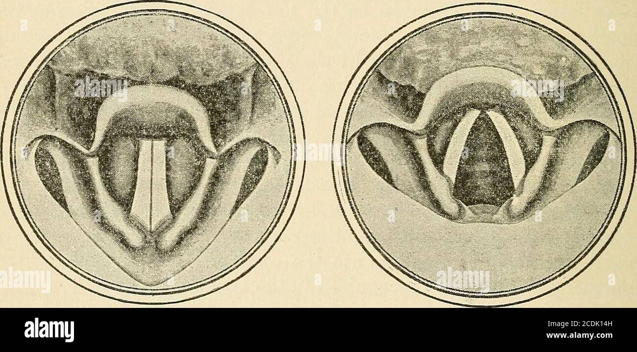Ventricular bands hi-res stock photography and images - Alamy