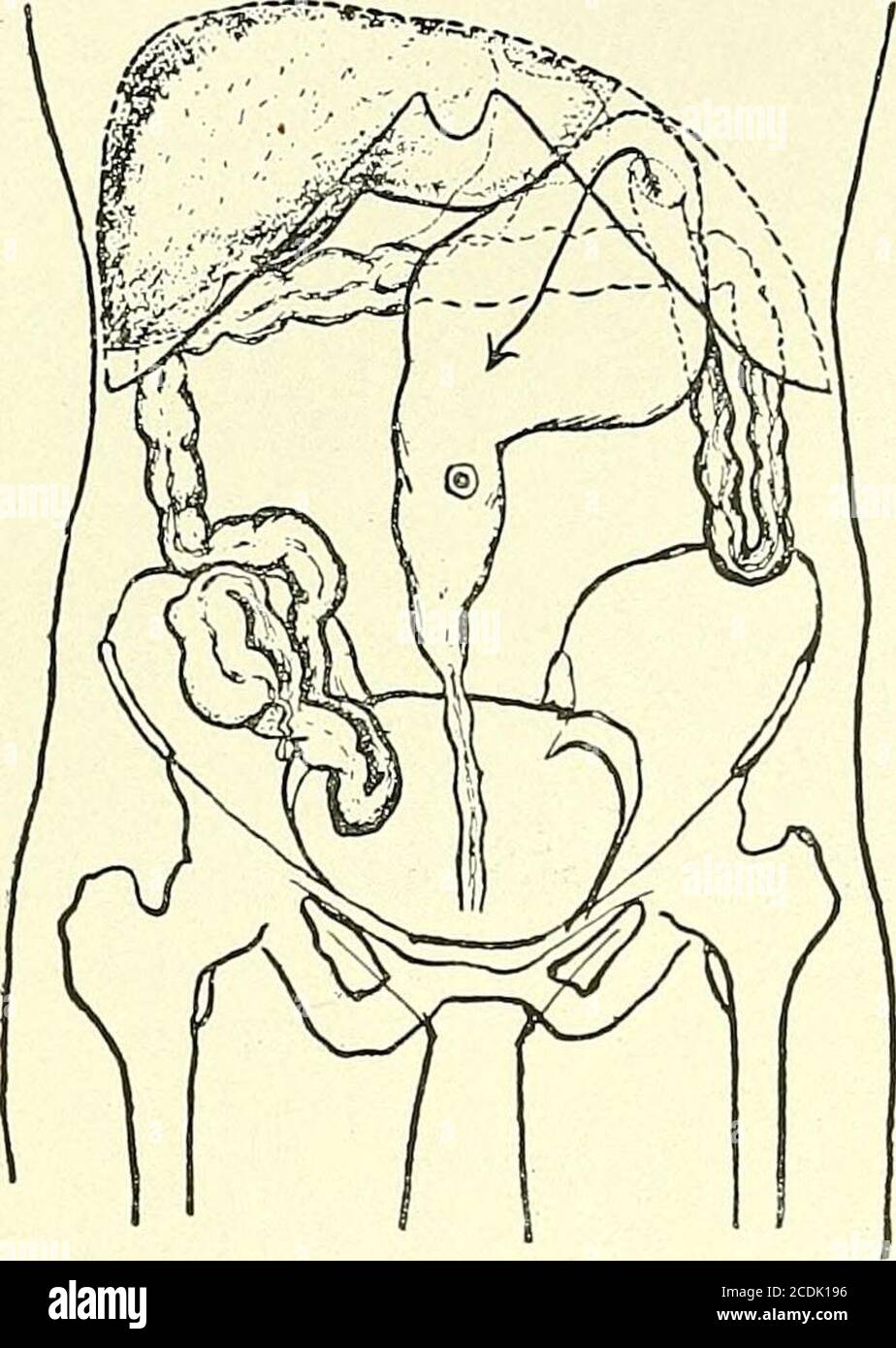 . Surgery, its principles and practice . Fig. 366.—View of Same Case ...