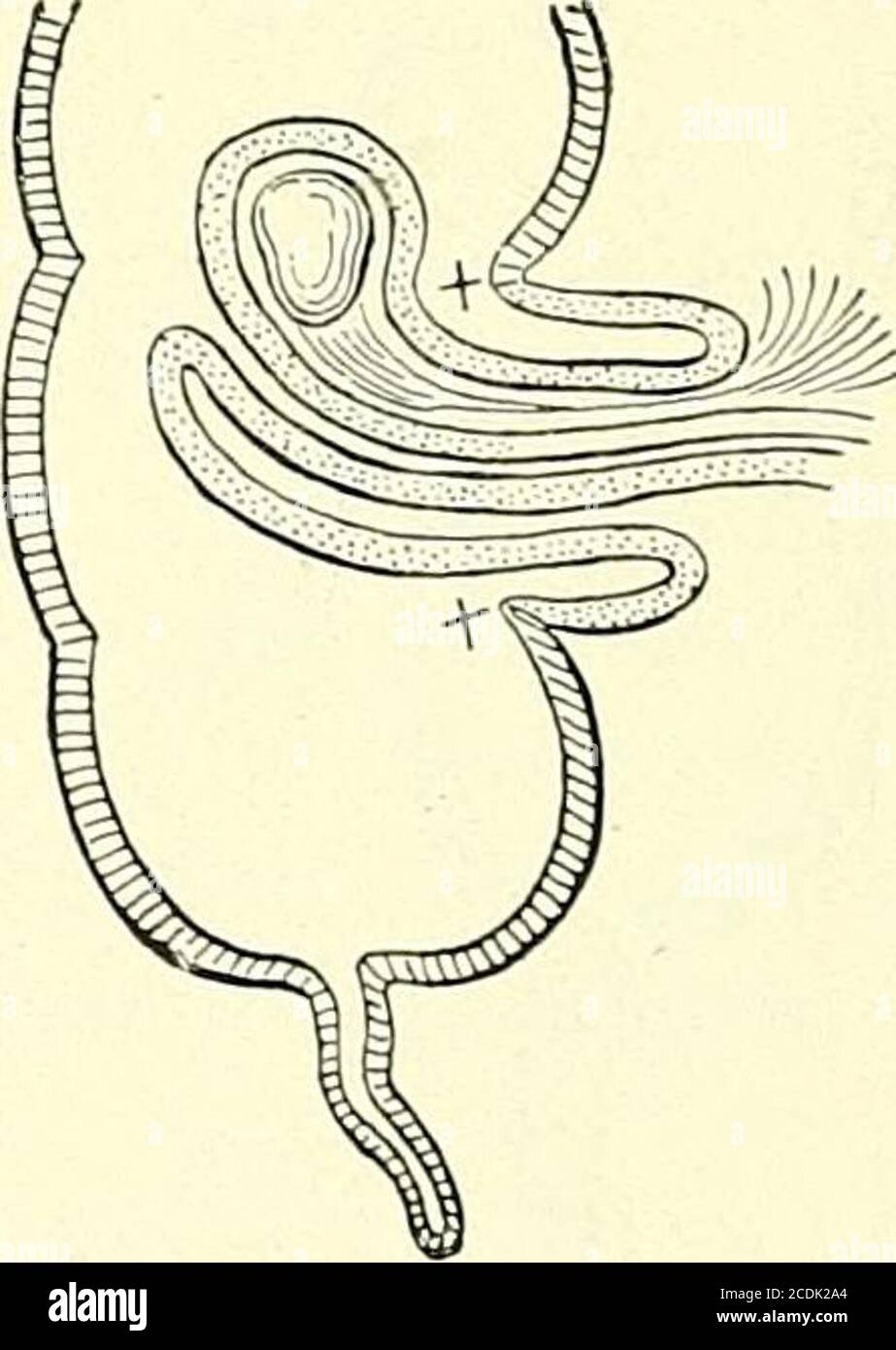 . Surgery, its principles and practice . Fig. 363.—Invagination Caused ...
