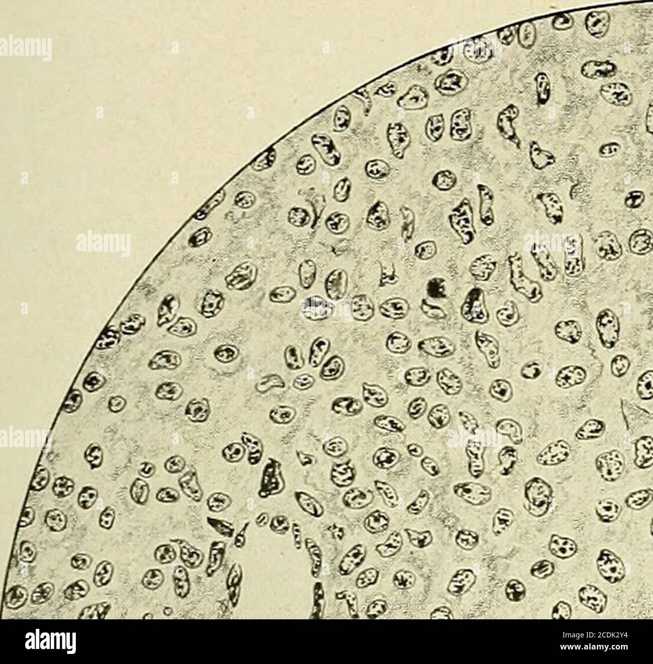 Parametrium Radical Hysterectomy Step By Step