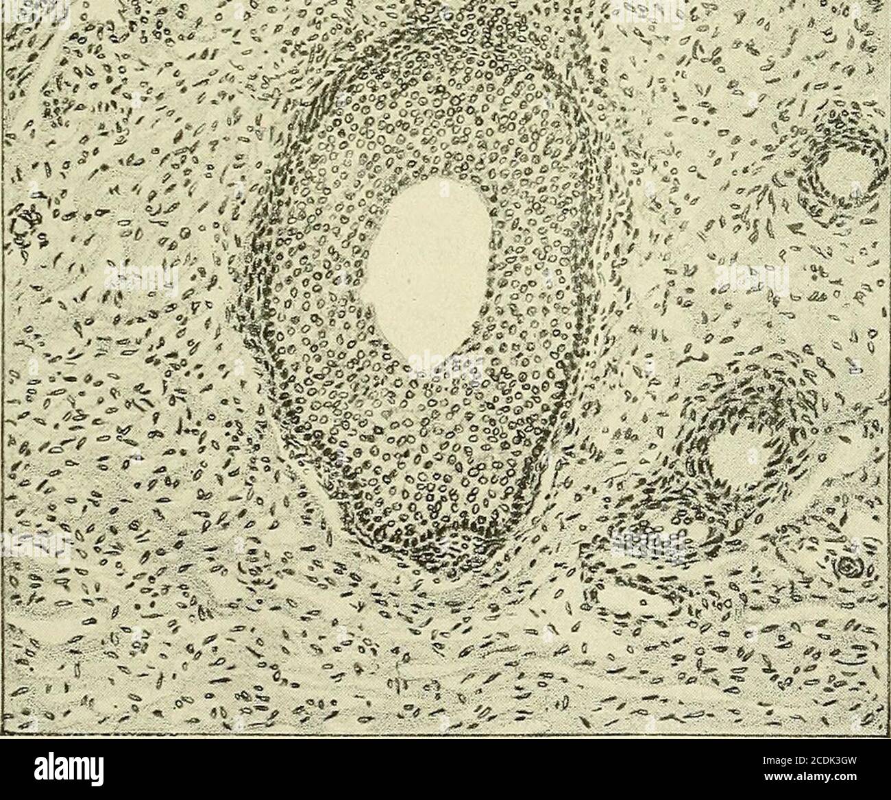 . Gynecology : . ^^fe°femV«S -sis v «? -Spifjisg,. Fig. 160.—Dermoid ...