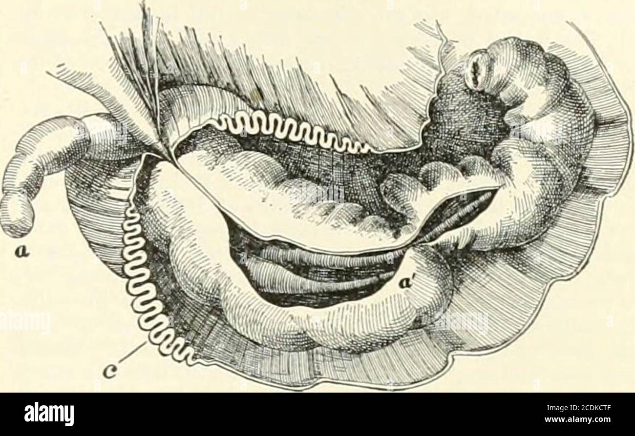 Intussusception High Resolution Stock Photography and Images - Alamy