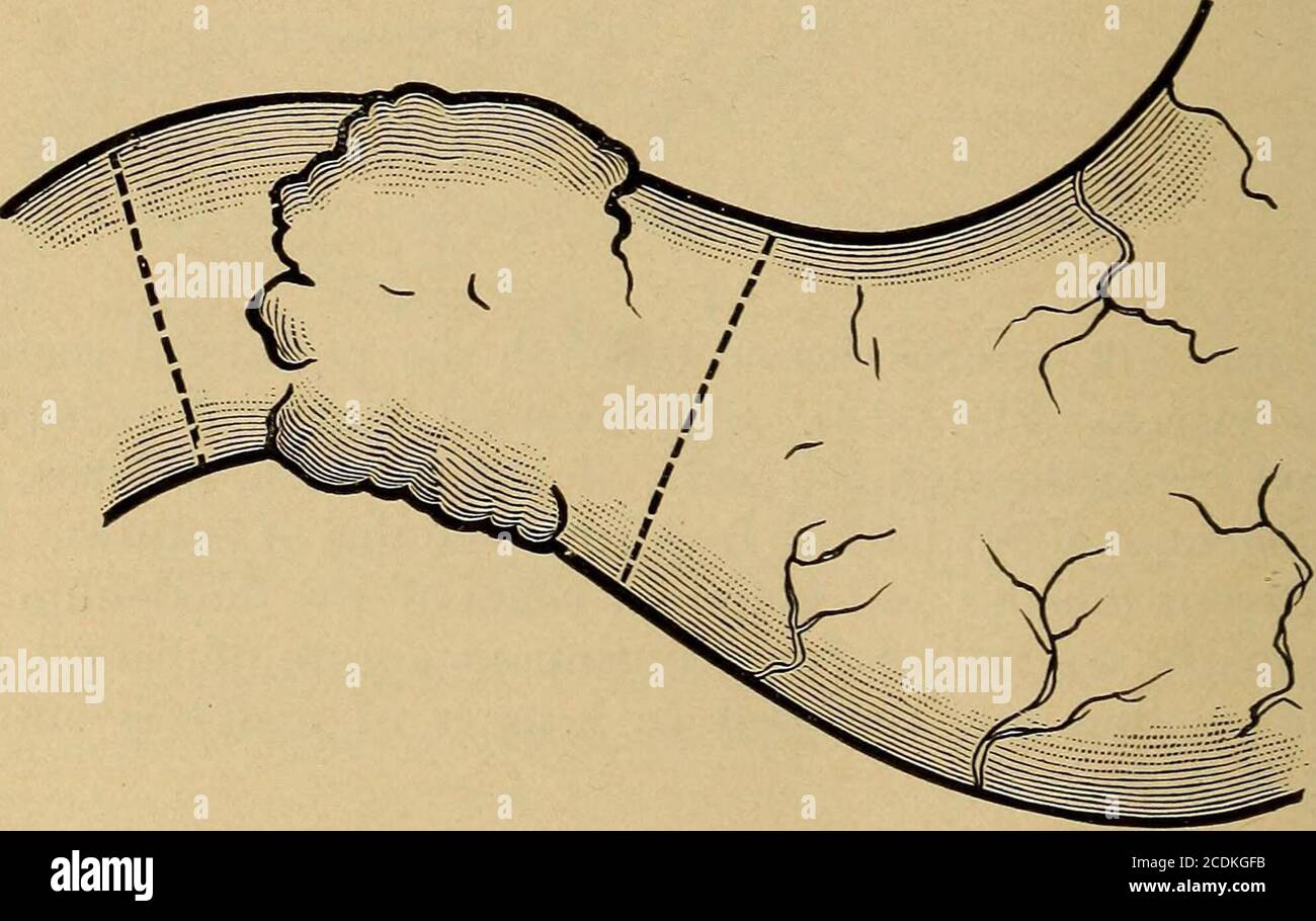 . Minor and operative surgery, including bandaging . Finneys operation ...