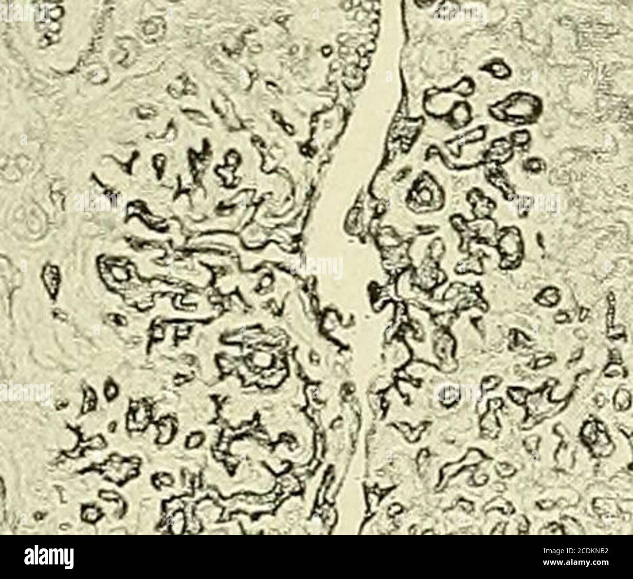. Gynecology : . lier invasion of the parametrium. It can be seen ...