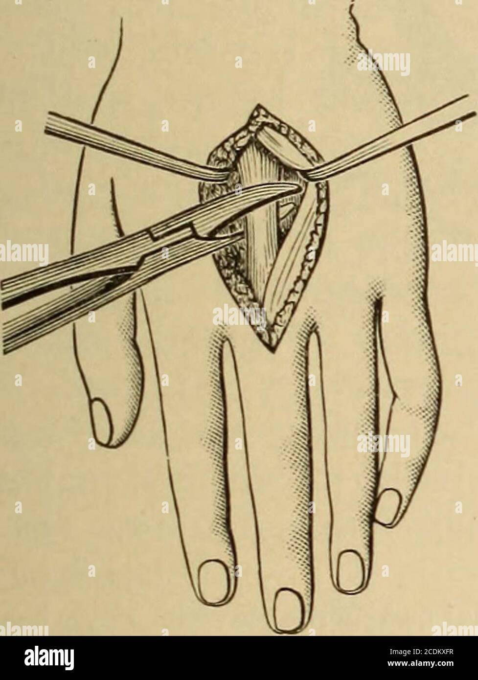 . Minor and operative surgery, including bandaging . IliMw Incision for ...