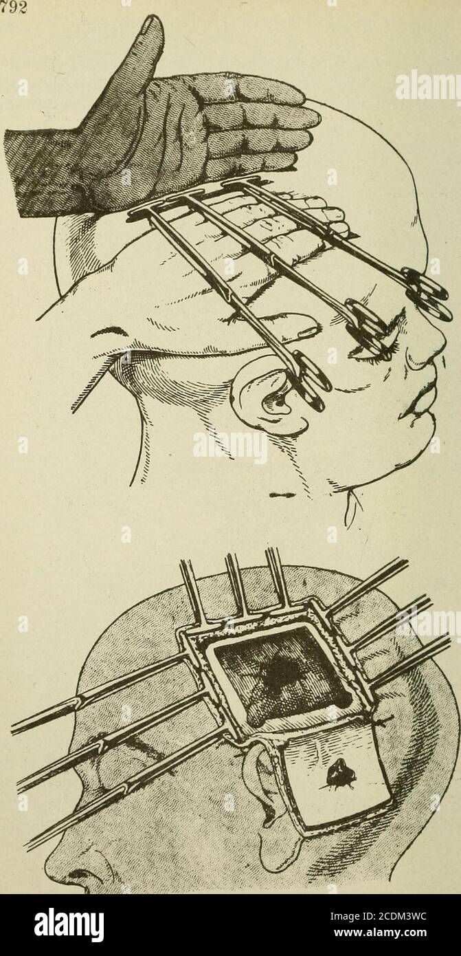 . Medical and surgical therapy . Fig. 16.—To prevent any haemorrhage ...