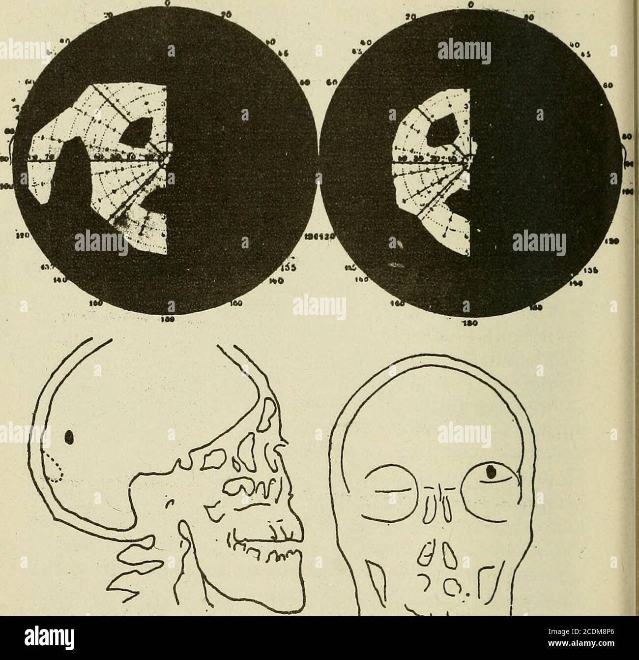 Scotomata hi-res stock photography and images - Alamy