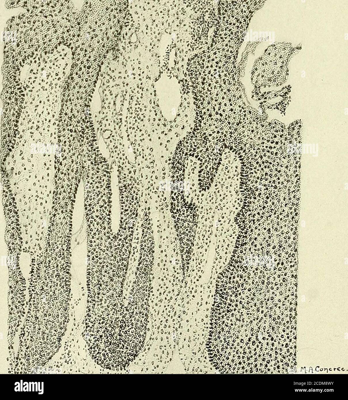 . Gynecology : . *?*&. ?:W-*-? V*. Fig. 48.—Condylomata Acuminata ...