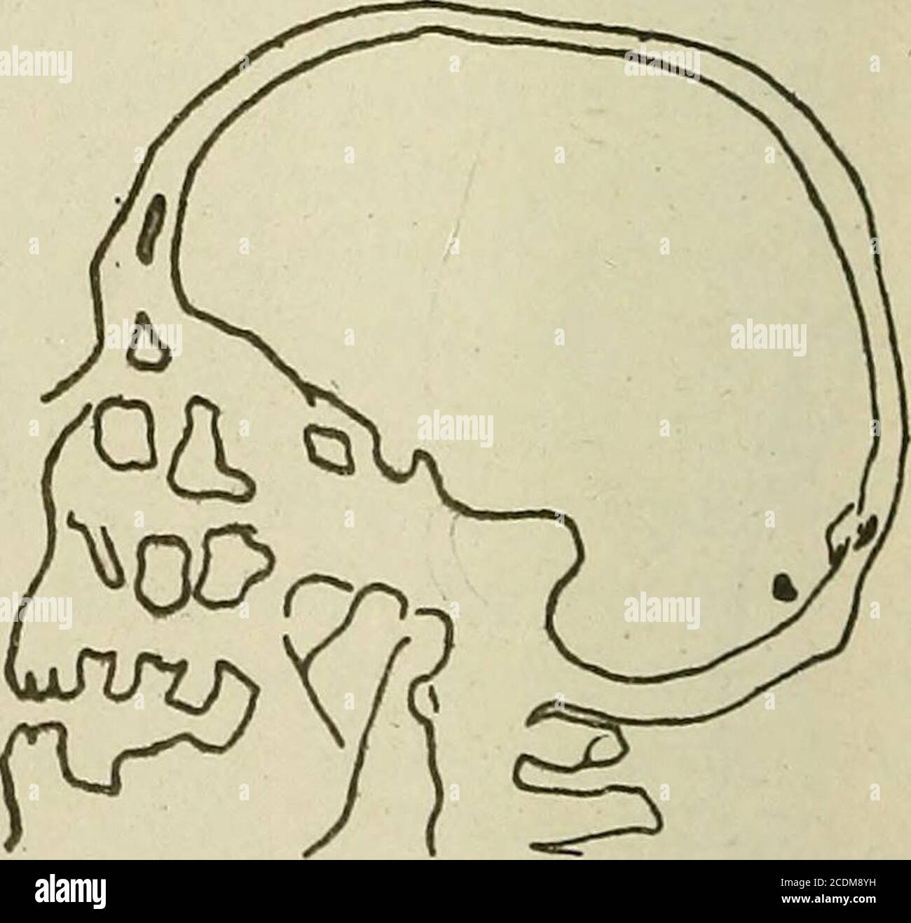 . Medical and surgical therapy . Fig. 31.—The wound of the skull. Fig ...
