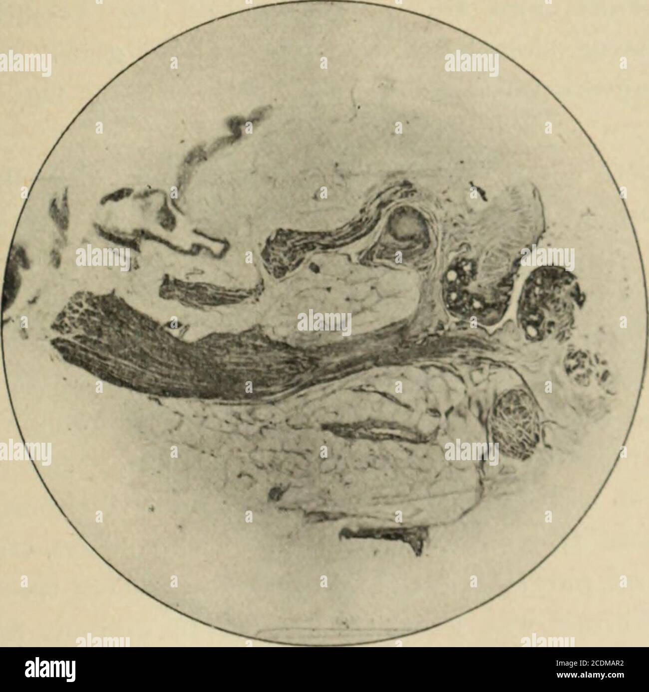 Conjunctival cyst hi-res stock photography and images - Alamy