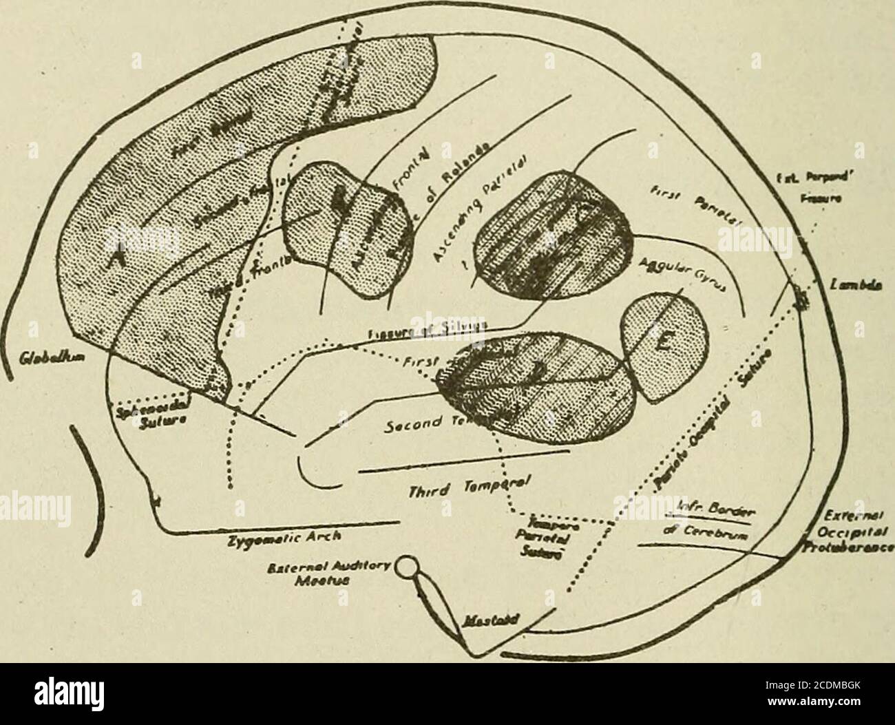 Parietal lobe lesion hi-res stock photography and images - Alamy