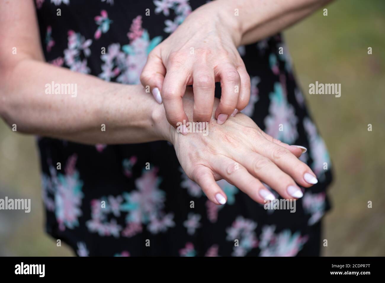 Woman having itchy and scratching her hand Stock Photo - Alamy