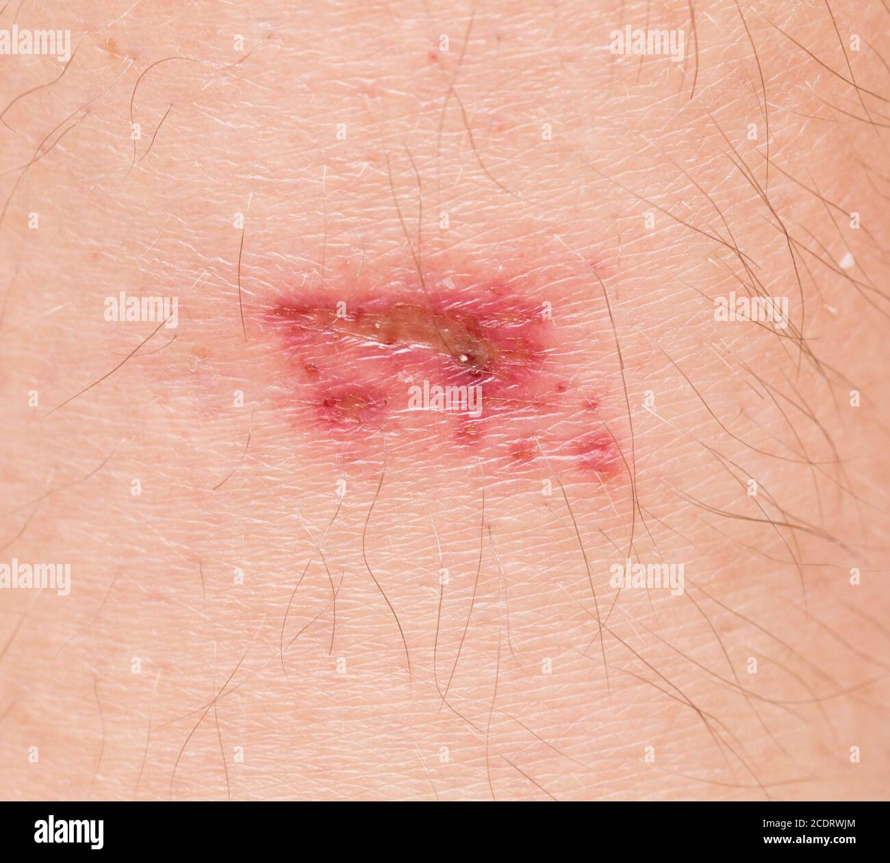 Scars on skin hi-res stock photography and images - Alamy
